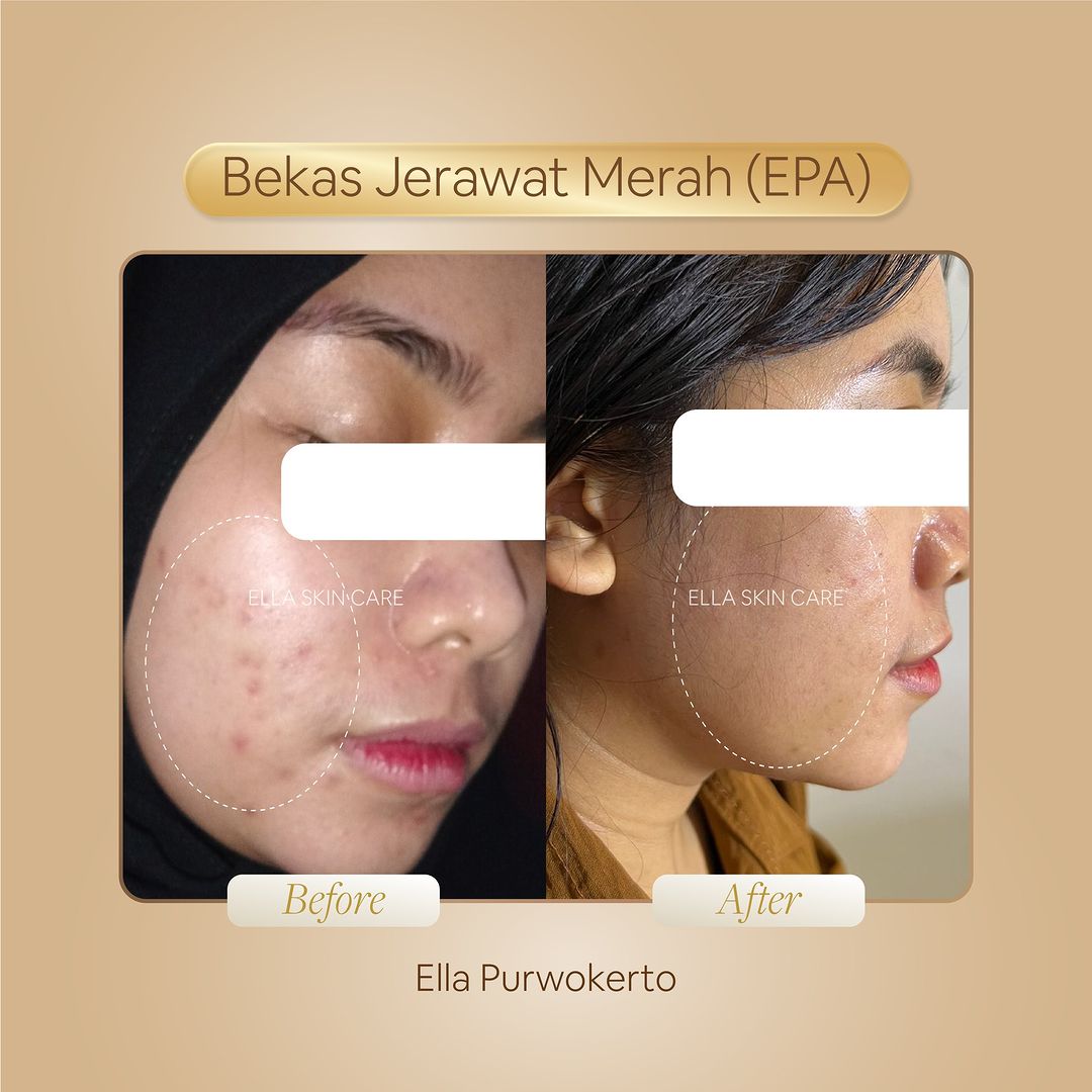 Hasil Nyata | Before After | Ella Skin Care